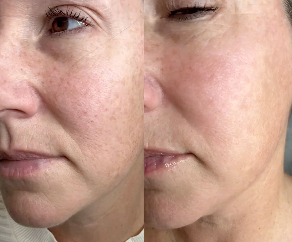 Rome MD | Deep Lifting System - Facelift Stamp – RomeMD