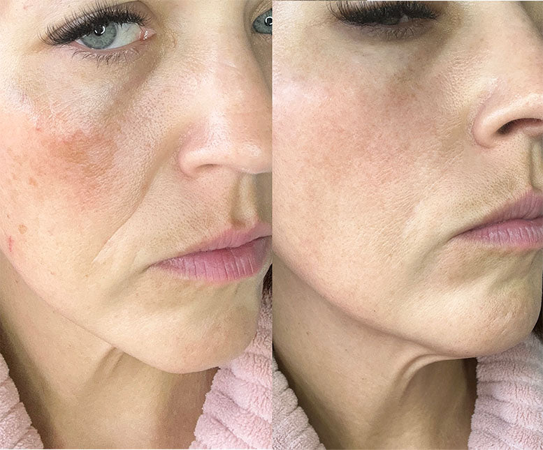 Rome MD | Deep Lifting System - Facelift Stamp – RomeMD