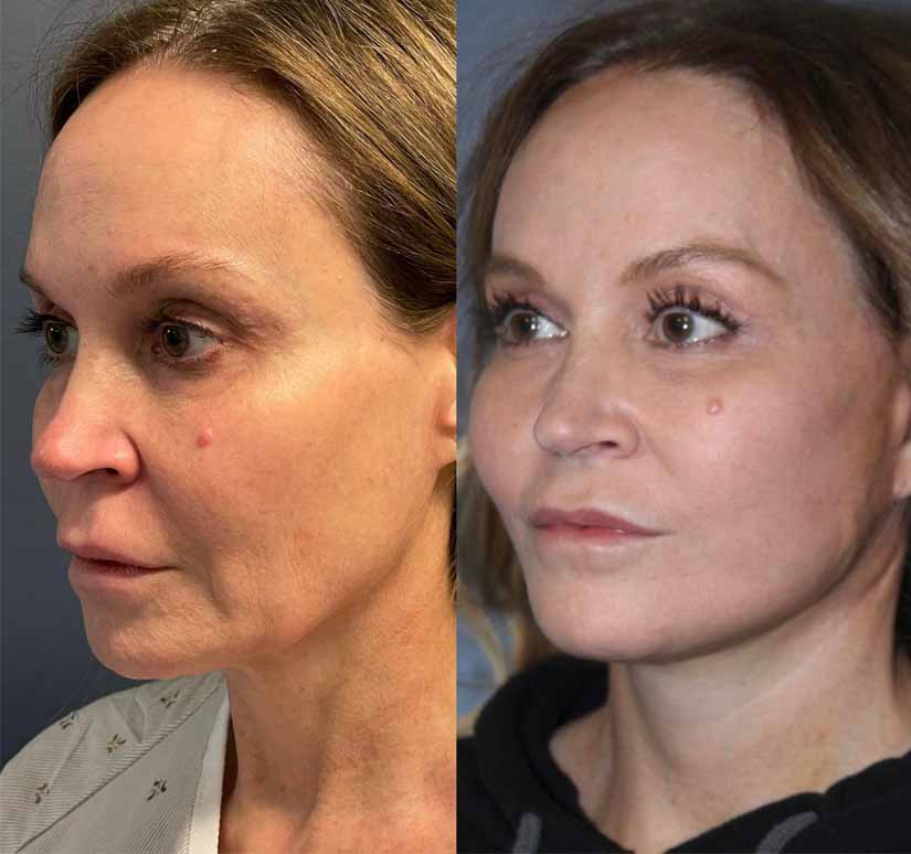 Deep Lifting System | Lift, Firm & Rejuvenate In 2 Minutes At Home – RomeMD